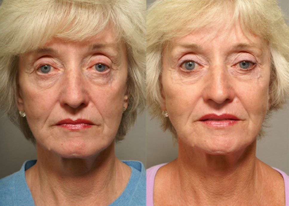 Cheek Implants – Benvenuti Plastic & Reconstructive Surgery